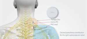 Peripheral Nerve Stimulation | Innovative Pain Care Center
