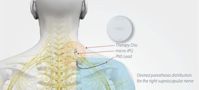 Peripheral Nerve Stimulation | Innovative Pain Care Center
